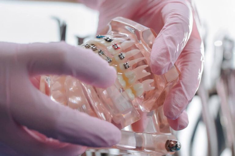 ¿Qué es el prognatismo mandibular y cómo se trata? - Clínicas Udemax